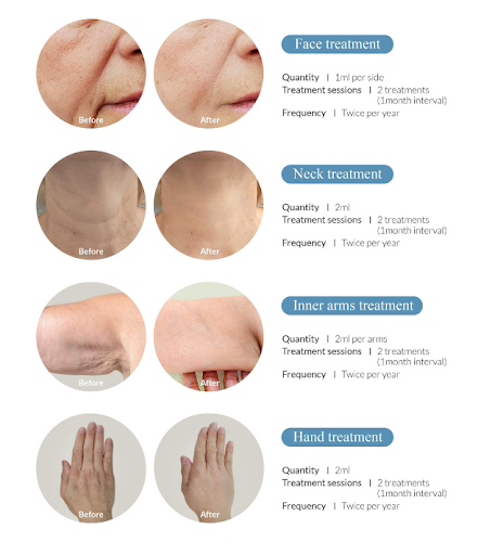 ULTRAHILO SKIN BOOSTER - FAROHA