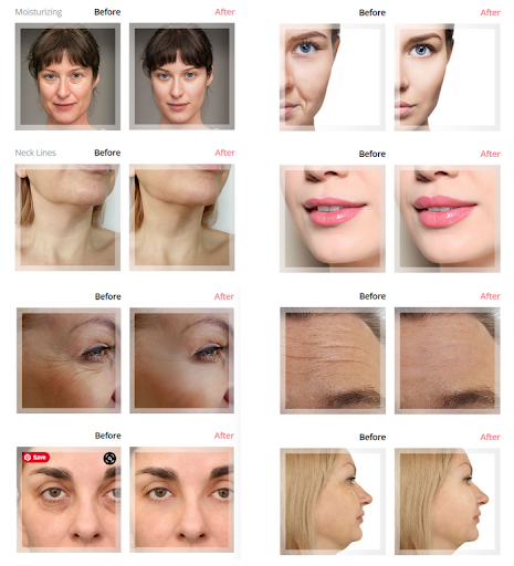 AESSOA DERMAL FILLERS - FAROHA