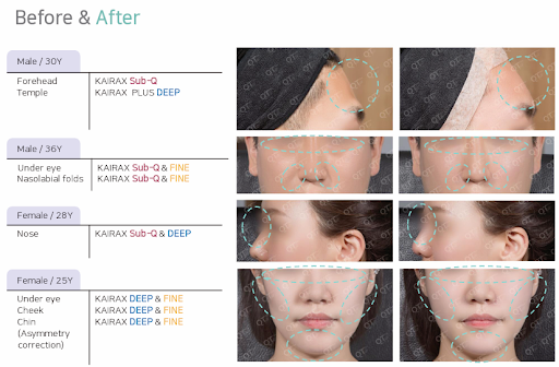 KAIRAX DERMAL FILLERS - FAROHA