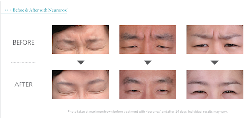 NEURONOX BOTULINUM TOXIN - FAROHA