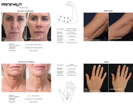 PROFHILO SKIN BOOSTER - FAROHA