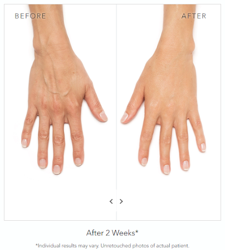 RADIESSE DERMAL FILLERS - FAROHA