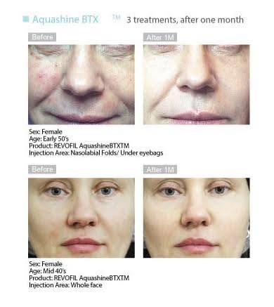 REVOFIL AQUASHINE DERMAL FILLERS - FAROHA