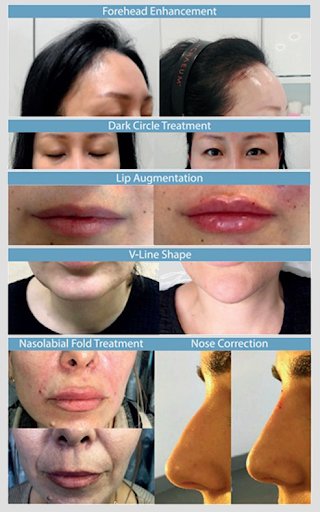 SERA FILL DERMAL FILLERS - FAROHA