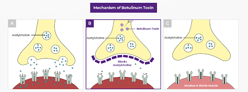 NEOTOX BOTULINUM TOXIN - FAROHA