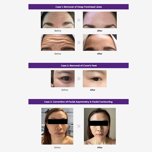 NEOTOX BOTULINUM TOXIN - FAROHA